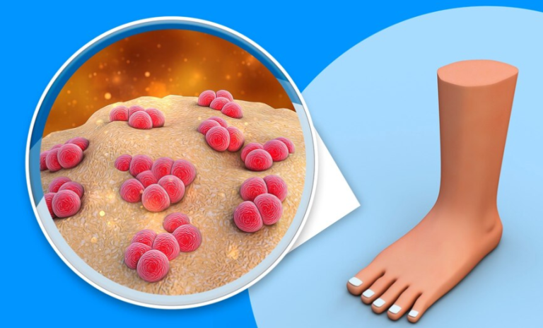 A Comprehensive Guide to Treating Diabetic Foot Ulcers by the Center ...